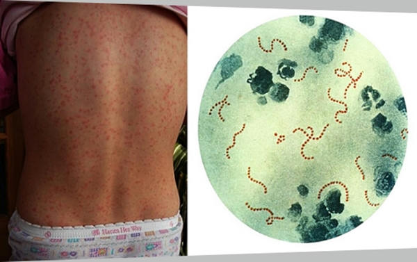 Denuncian reaparición de la escarlatina, una enfermedad que se creía ...